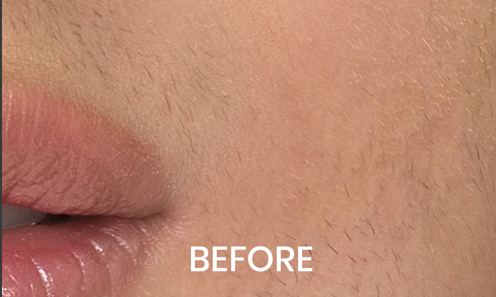 How Does IPL Hair Removal Work? | Naisigoo The Shiner